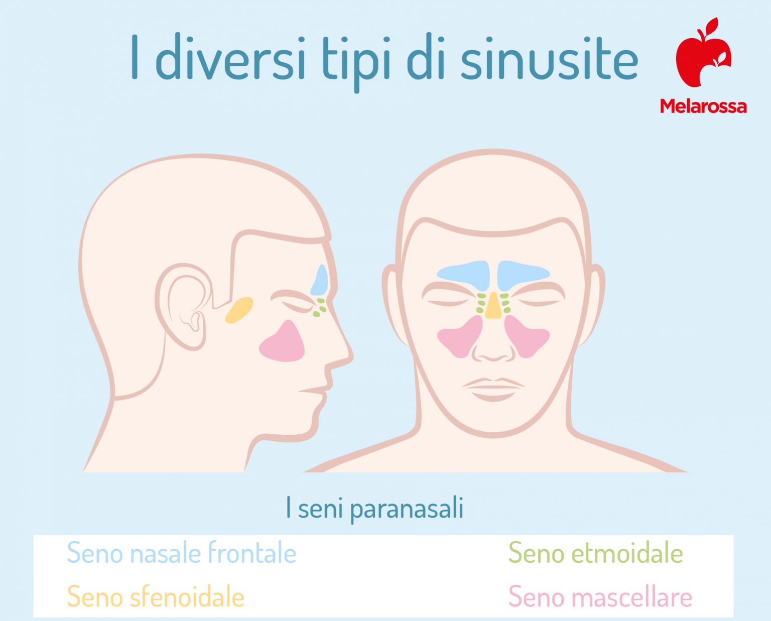 Sinusite: cos'è, sintomi, rimedi e come si cura