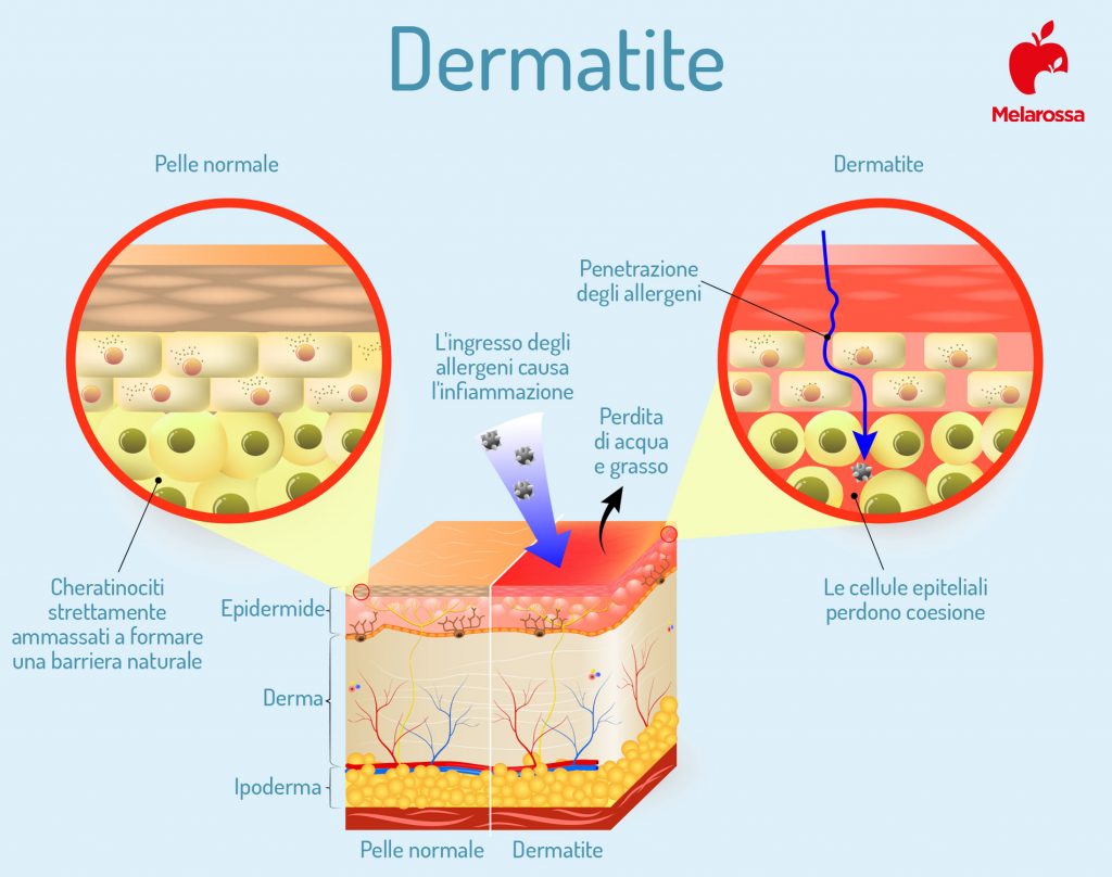 Dermatite: cos’è, tipologie principali, cause, sintomi, cura e trattamento