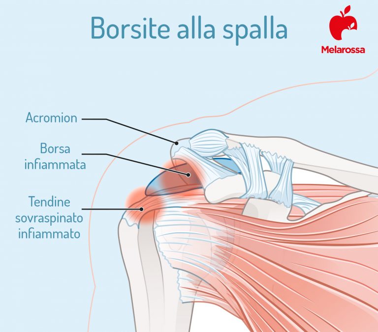 Borsite: che cos’è, tipi, cause e fattori di rischio, sintomi, diagnosi ...