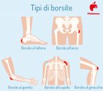 Borsite: che cos’è, tipi, cause e fattori di rischio, sintomi, diagnosi ...