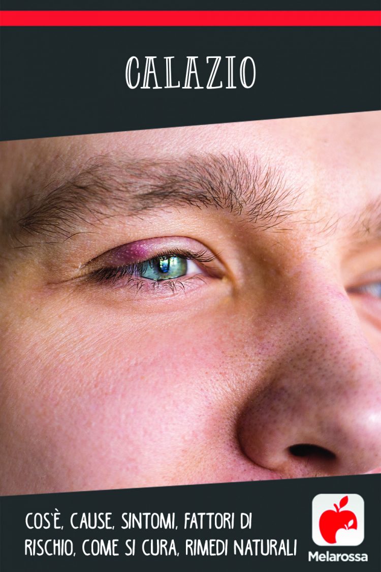 Calazio: cos’è, cause, sintomi, diagnosi, come si cura, rimedi naturali