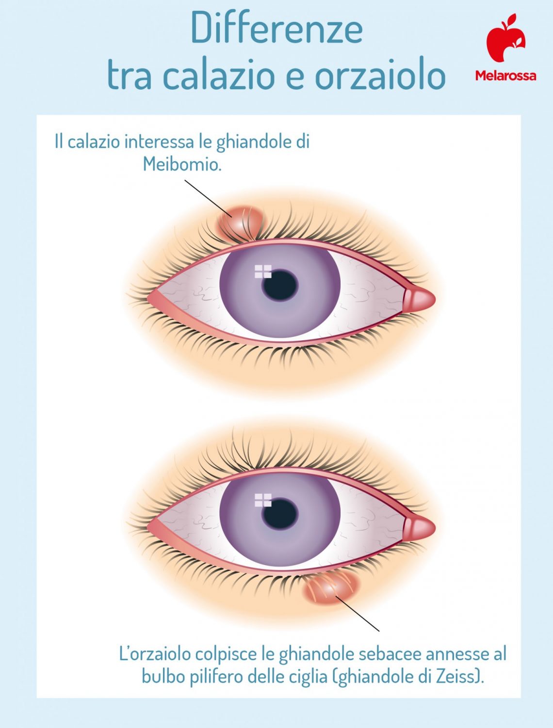 Calazio: cos’è, cause, sintomi, diagnosi, come si cura, rimedi naturali