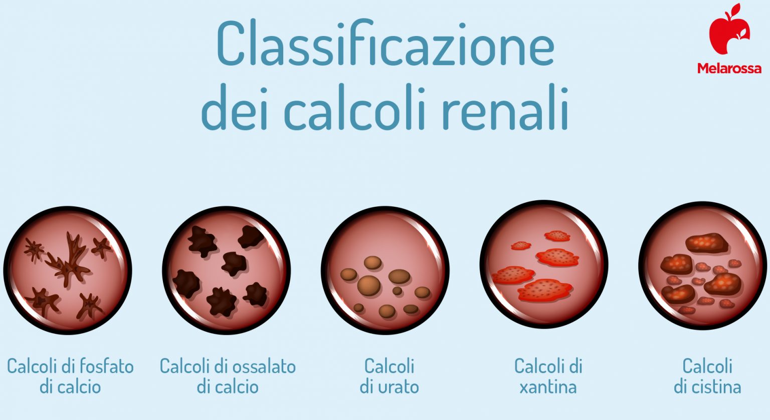 Calcoli renali: cosa sono, sintomi, cause, cura e prevenzione