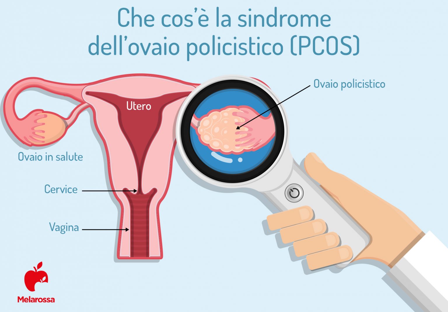 Ovaio policistico e sindrome: differenze, sintomi, cause e cure