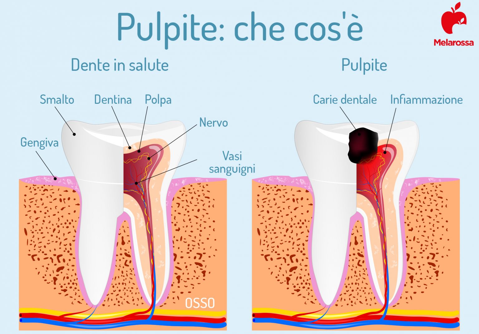Pulpite dentale: cos'è, tipi, cause, sintomi cure e prevenzione