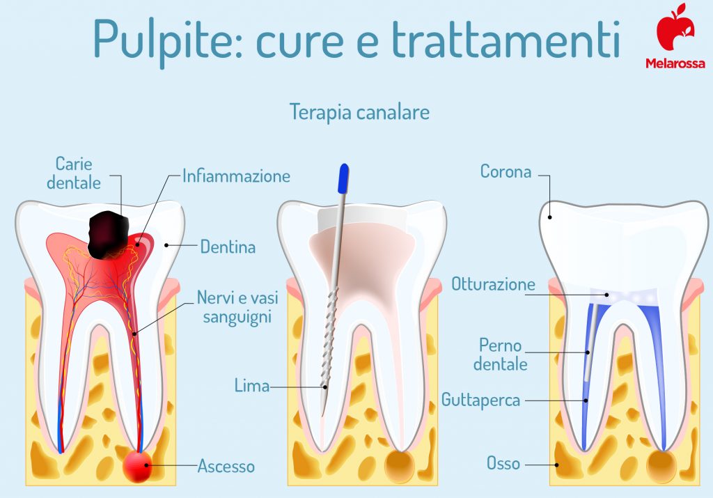 Pulpite dentale: cos'è, tipi, cause, sintomi cure e prevenzione
