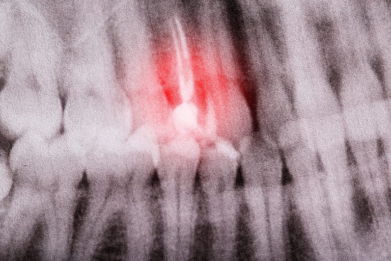 Pulpite dentale: cos'è, tipi, cause, sintomi cure e prevenzione