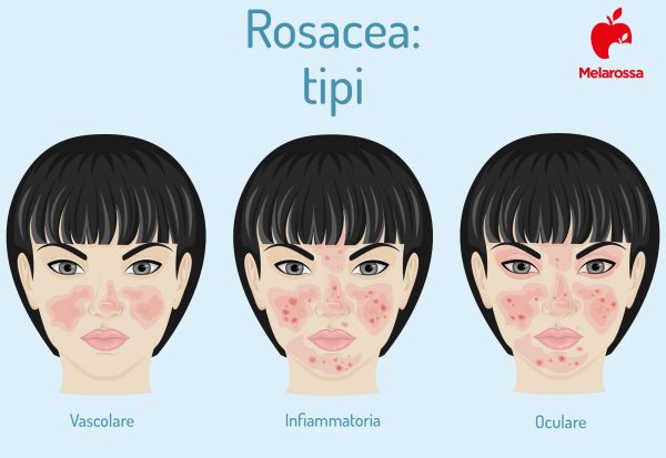 Rosacea: cos’è, cause e fattori di rischio, sintomi e trattamenti