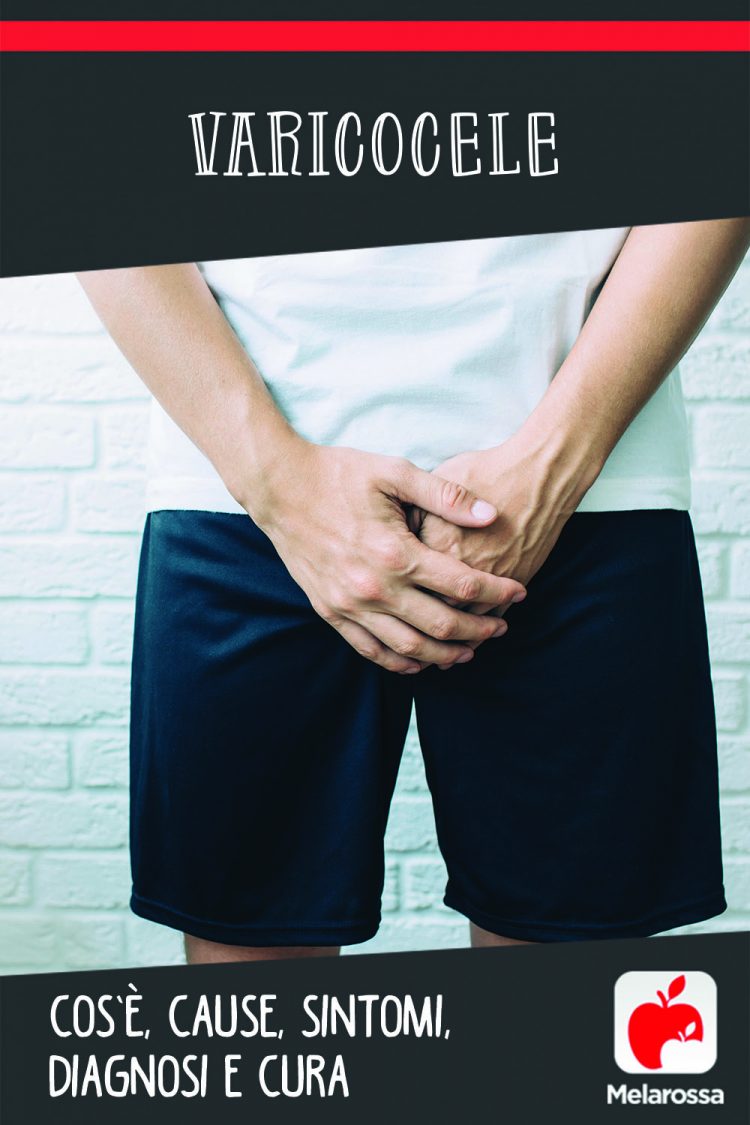 Varicocele: cos’è, cause, sintomi, diagnosi e cura- Melarossa