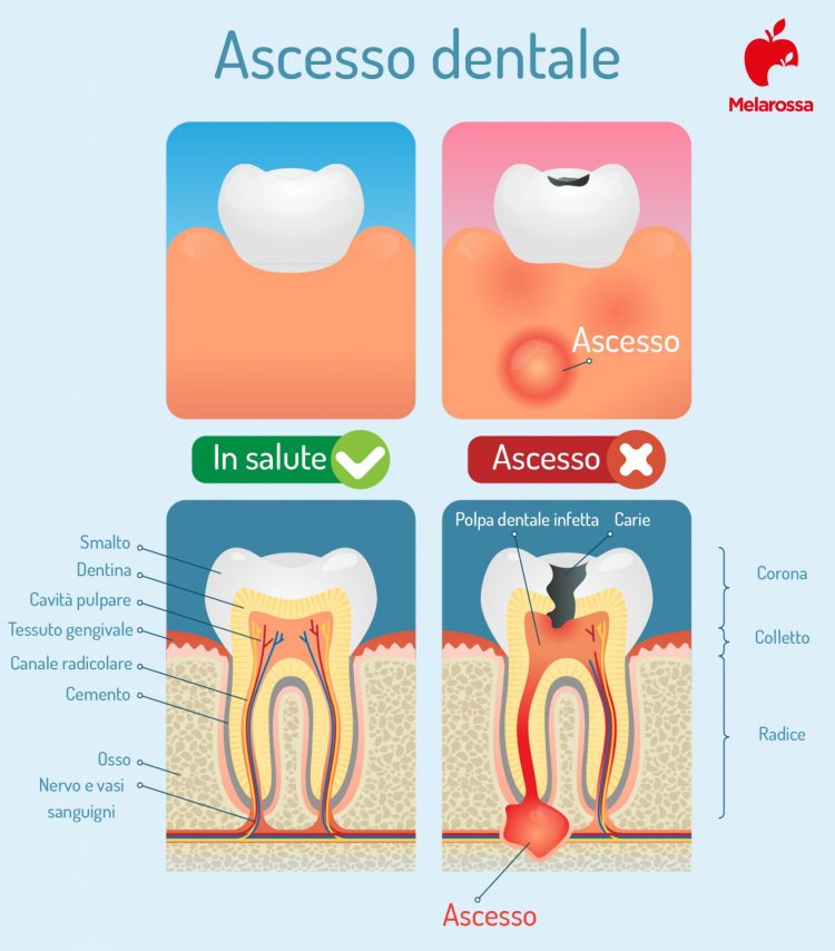 Ascesso dentale: cos’è, cause, sintomi, cure, prevenzione