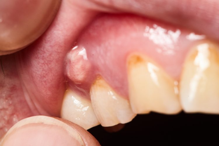 Ascesso dentale: cos’è, cause, sintomi, cure, prevenzione