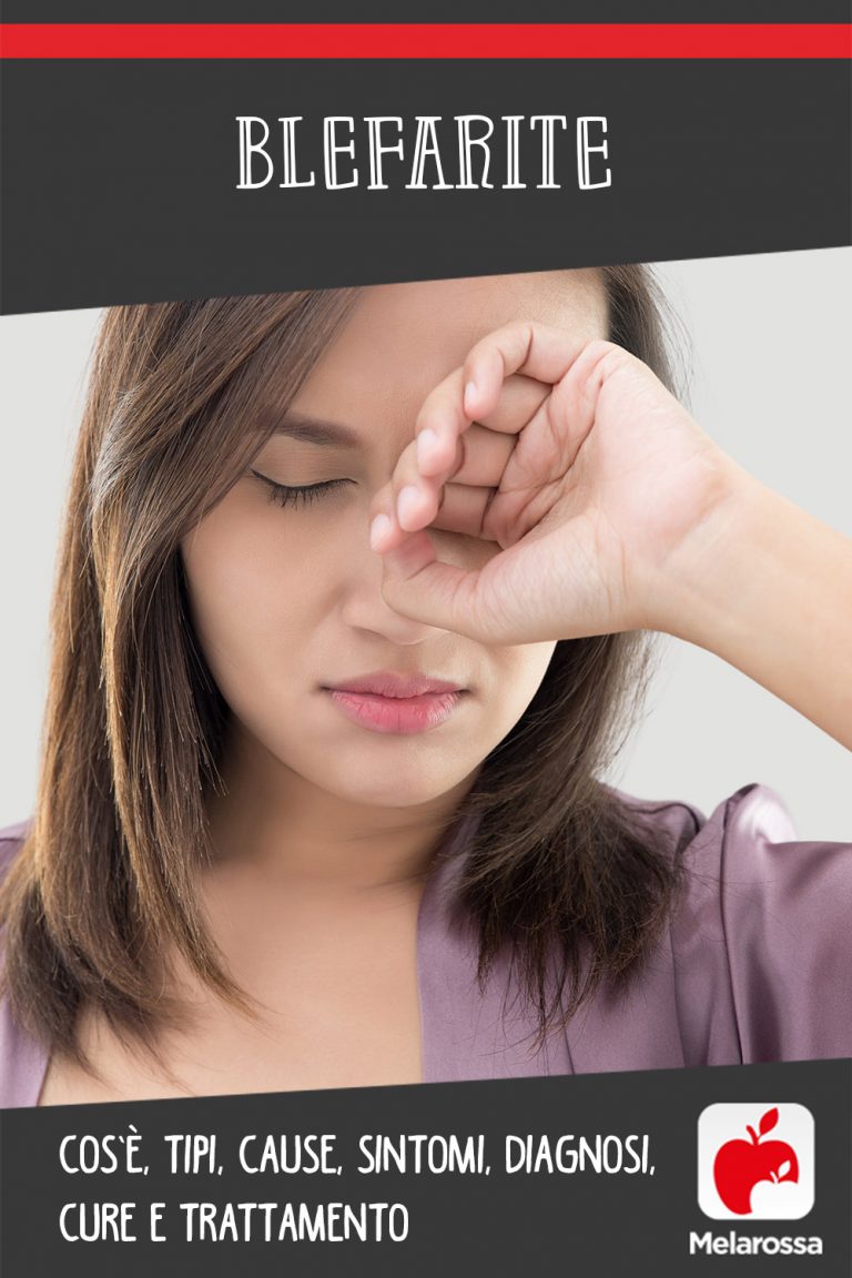 Blefarite: cos’è, tipi, cause, sintomi, diagnosi, cure e trattamento