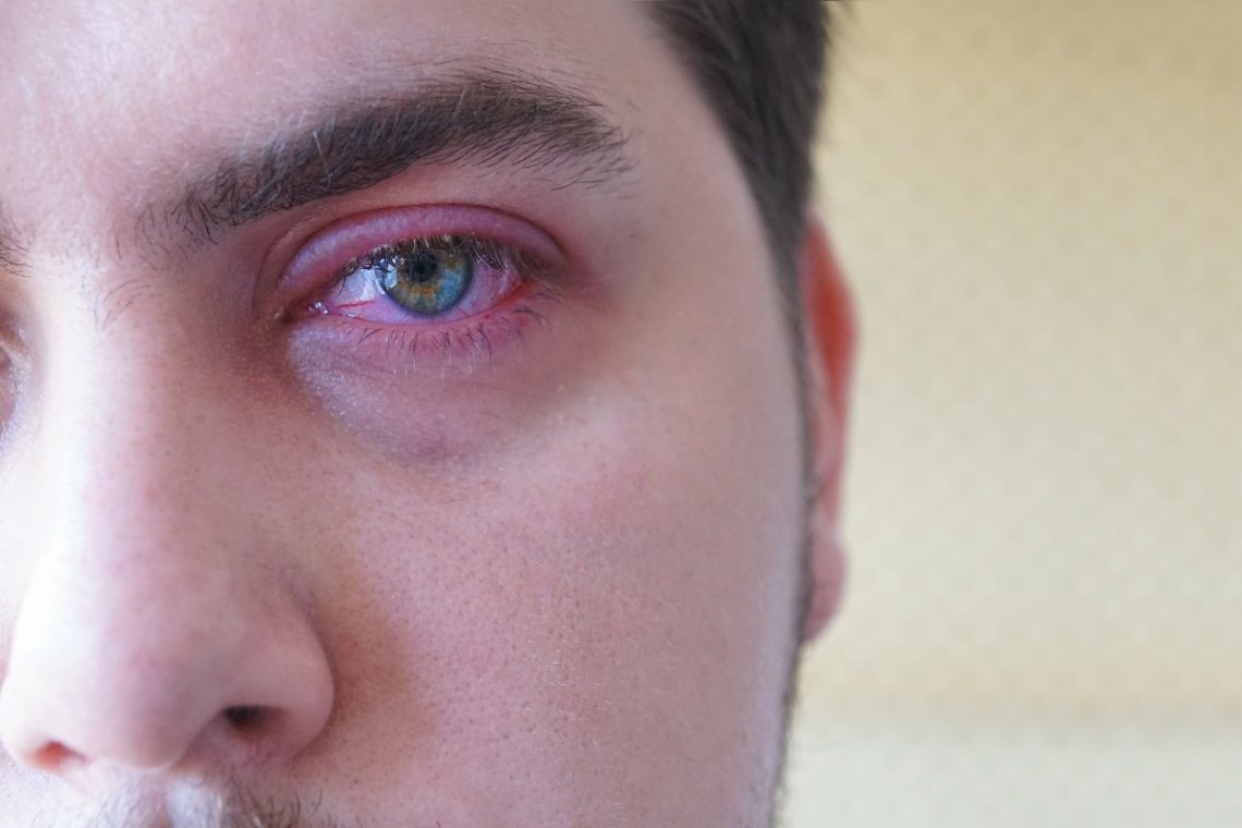 Blefarite: cos’è, tipi, cause, sintomi, diagnosi, cure e trattamento