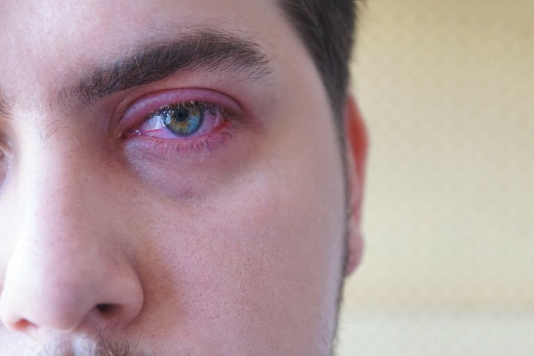 Blefarite: cos’è, tipi, cause, sintomi, diagnosi, cure e trattamento