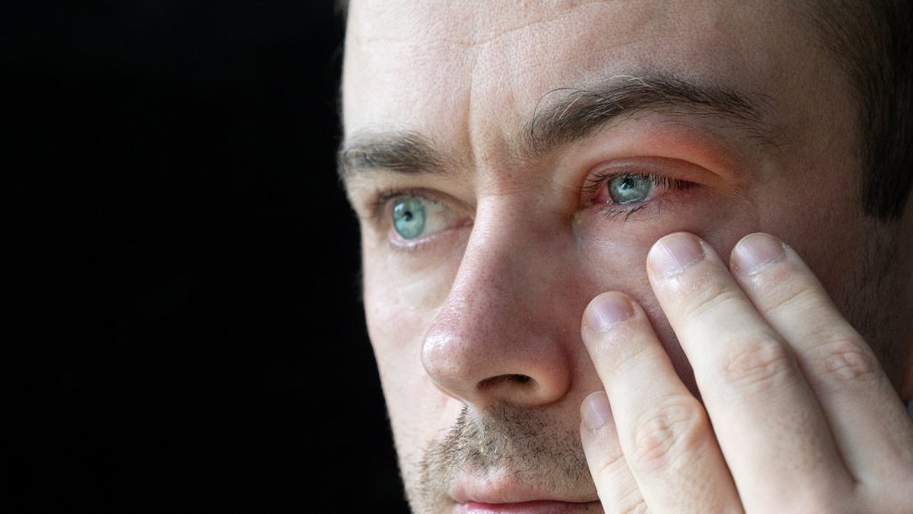 Blefarite: cos’è, tipi, cause, sintomi, diagnosi, cure e trattamento