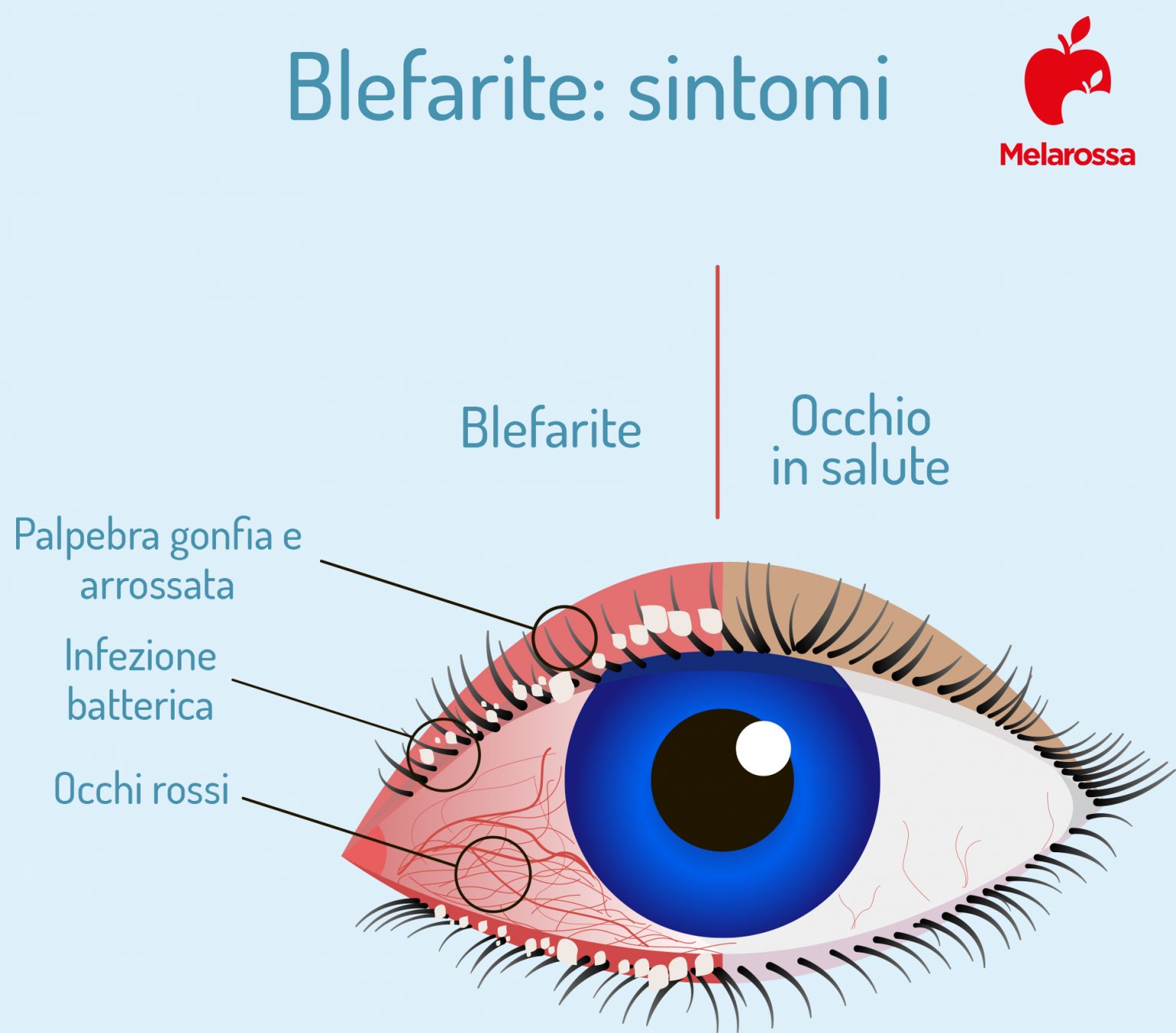 Blefarite: cos’è, tipi, cause, sintomi, diagnosi, cure e trattamento