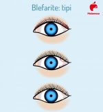Blefarite: cos’è, tipi, cause, sintomi, diagnosi, cure e trattamento
