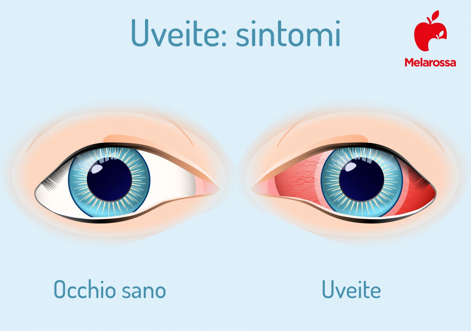 Uveite all’occhio: cos’è, quanti tipi esistono, cause, sintomi ...