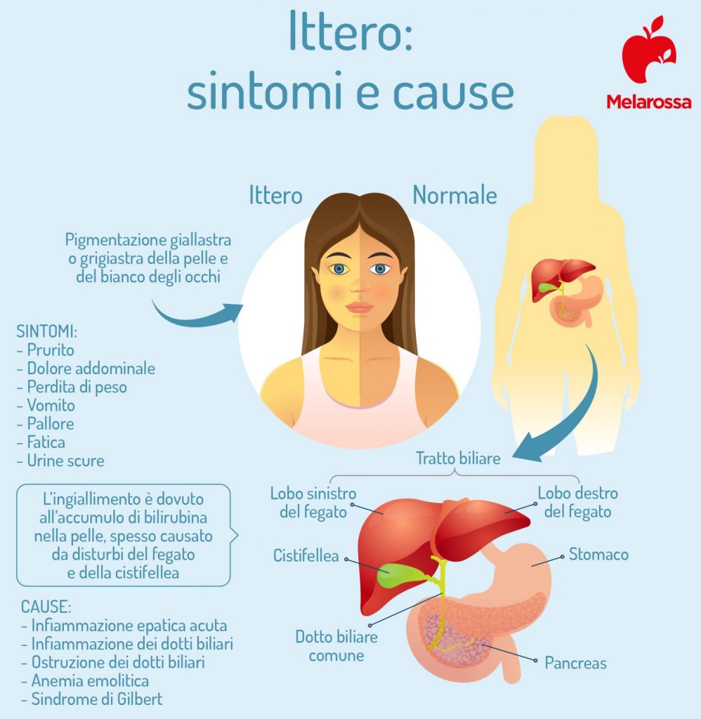 Ittero: cos’è, sintomi, tipologie, cause, diagnosi, cure e prevenzione