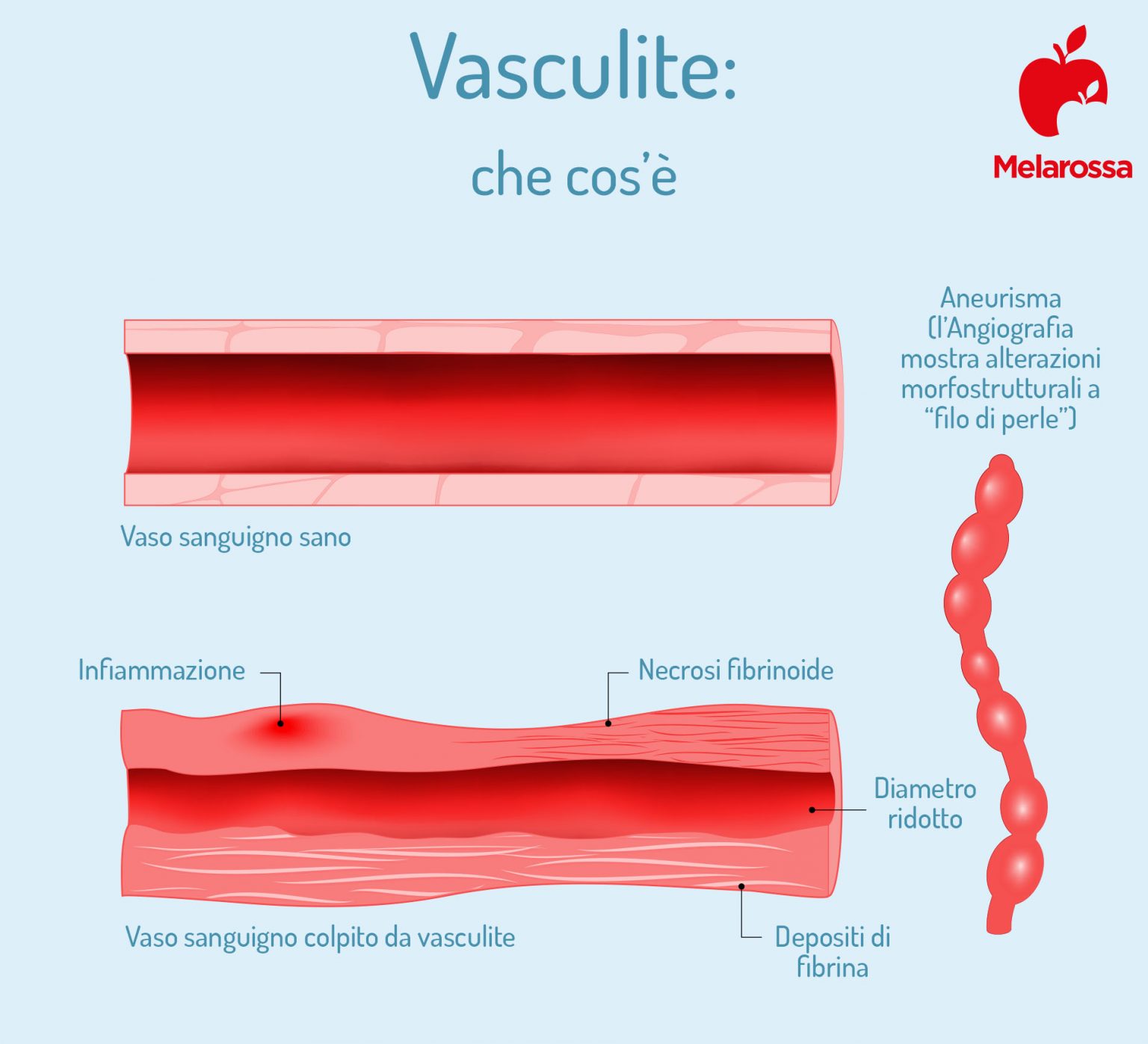Vasculite: cos’è, sintomi, classificazione, cause, diagnosi, cure