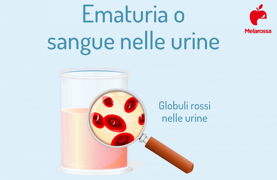 Sangue nelle urine: cos’è, cause e rimedi dell'ematuria