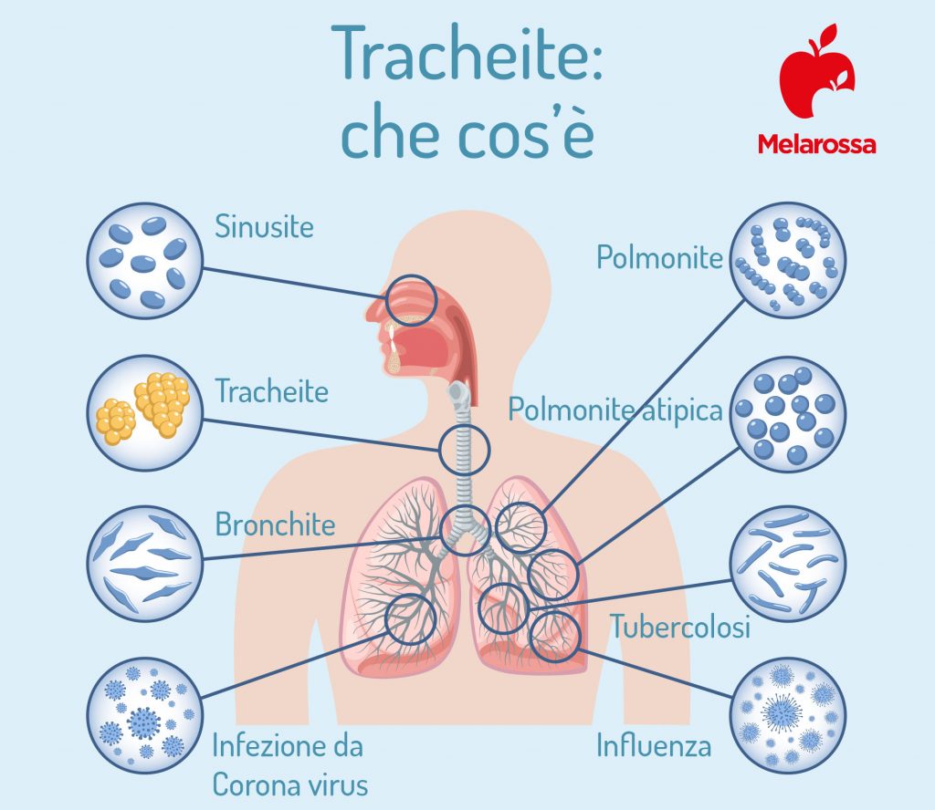 Tracheite: cos’è, quali sono i sintomi e le cause, cura e trattamento