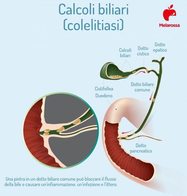 Calcoli biliari: cosa sono, sintomi, cause, diagnosi e cura