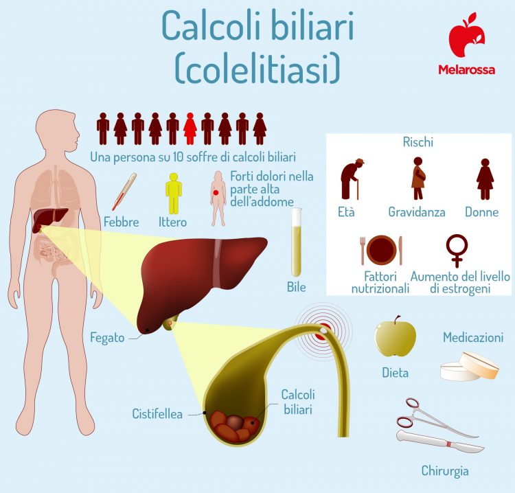 Calcoli biliari: cosa sono, sintomi, cause, diagnosi e cura