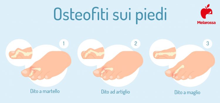 Osteofitosi: cos’è, cause, sintomi, tipi di osteofiti, diagnosi, cure e ...