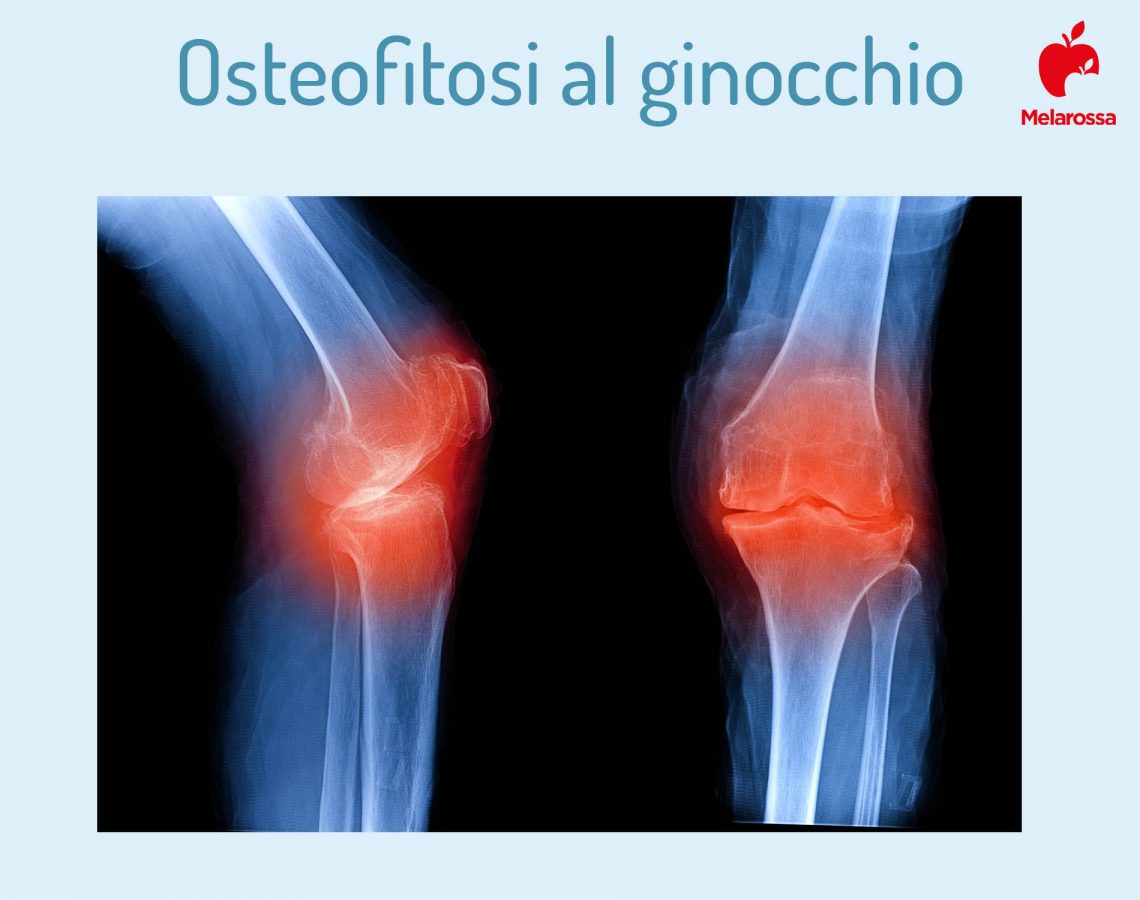 Osteofitosi: cos’è, cause, sintomi, tipi di osteofiti, diagnosi, cure e ...