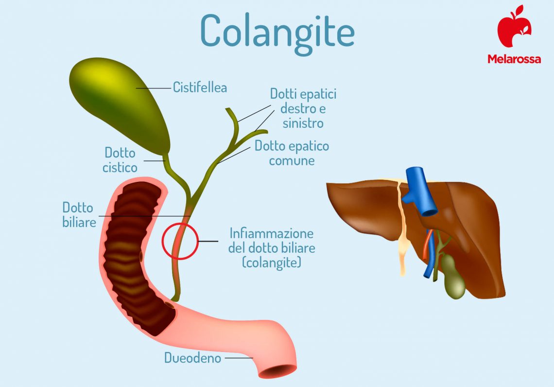 Colangite: cos’è, sintomi, cause e trattamento