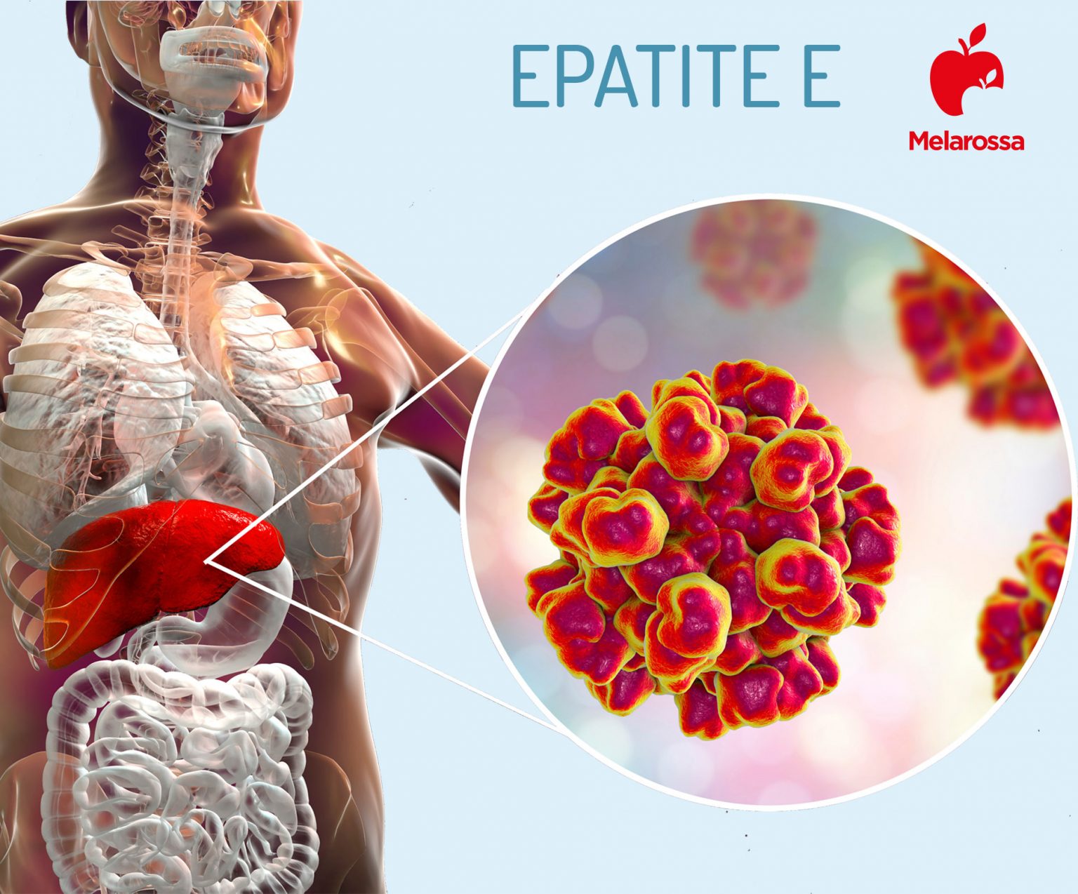 Epatite E: cos’è, sintomi, cause, cure e trattamenti, dieta da seguire