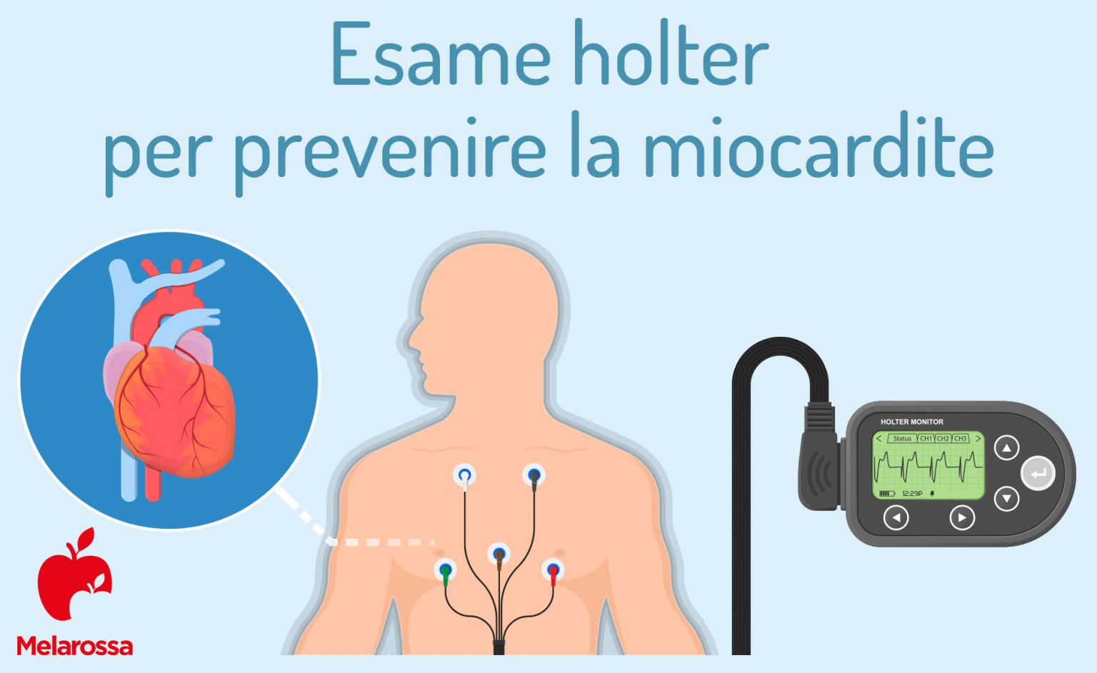 Miocardite: cos’è, sintomi, cause, diagnosi e cura