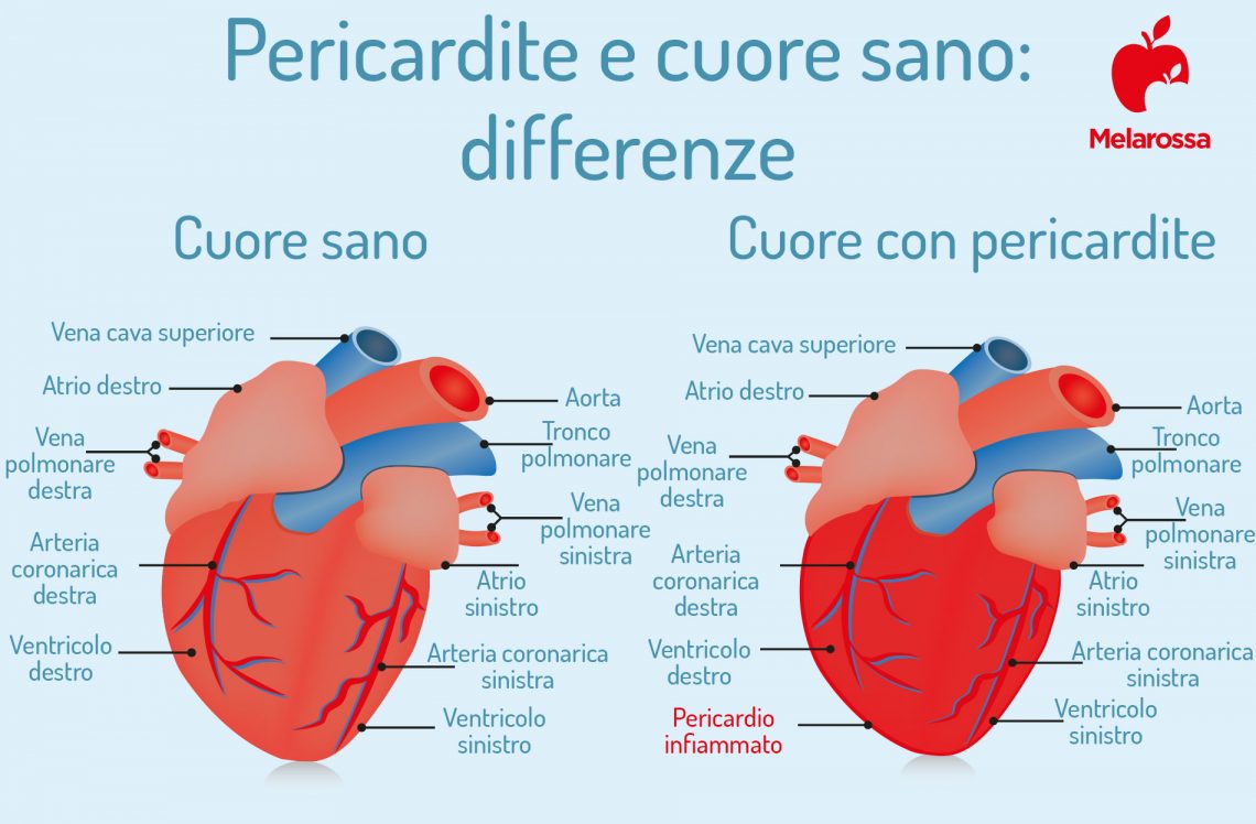 Pericardite: cos'è, quali sono i sintomi, le cause e la cura più efficace