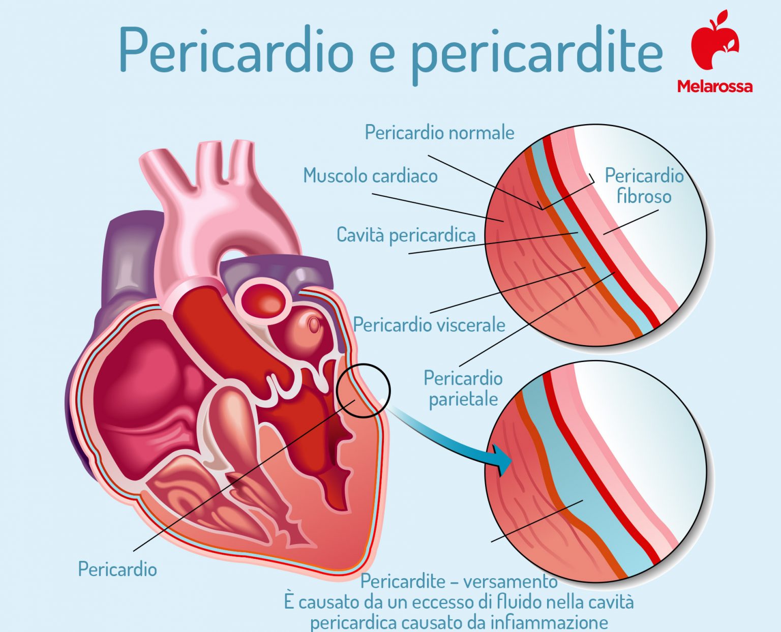 Pericardite: cos'è, quali sono i sintomi, le cause e la cura più efficace