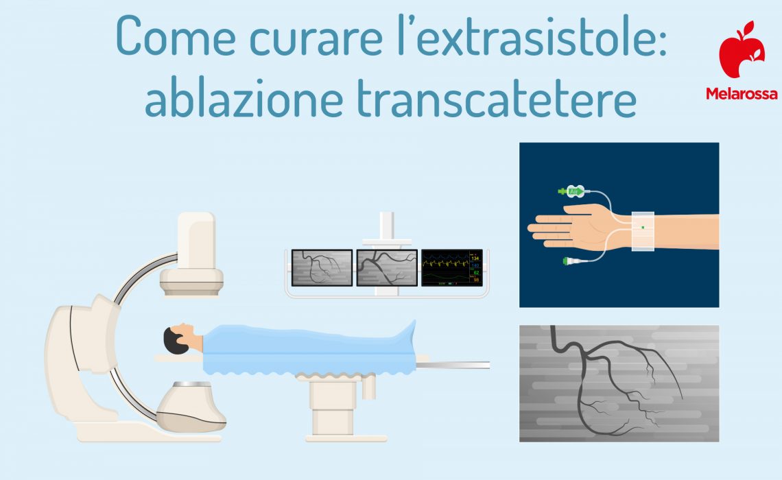 Extrasistole: cos’è, tipi, cause, sintomi, diagnosi e cure