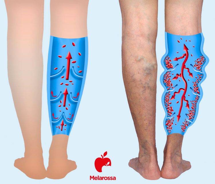 Vene varicose: cosa sono, sintomi, cause e rimedi delle varici
