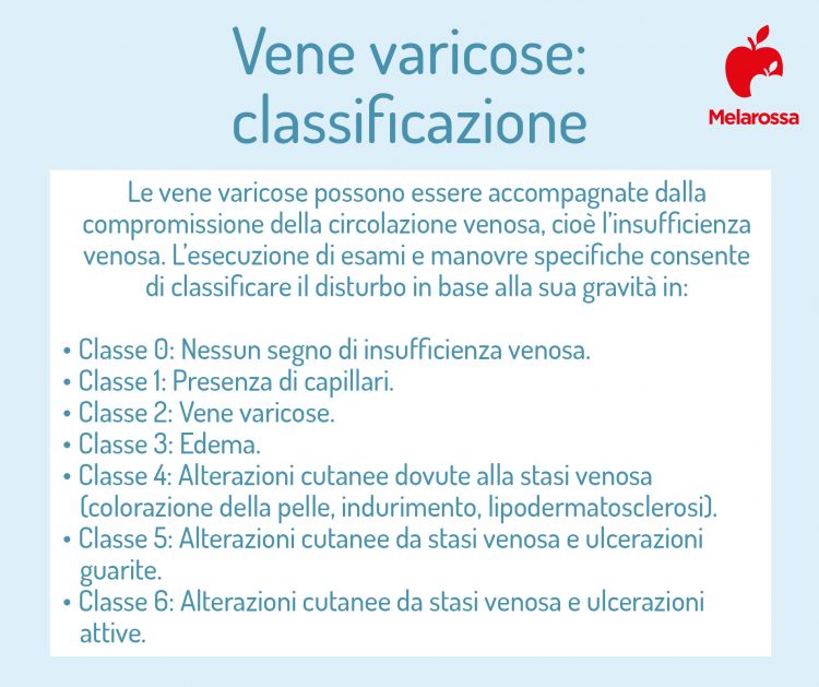 Vene varicose: cosa sono, sintomi, cause e rimedi delle varici