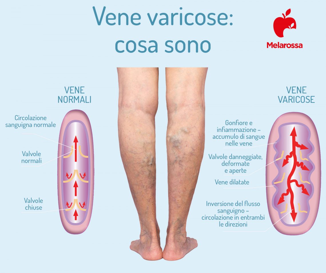 Vene varicose: cosa sono, sintomi, cause e rimedi delle varici