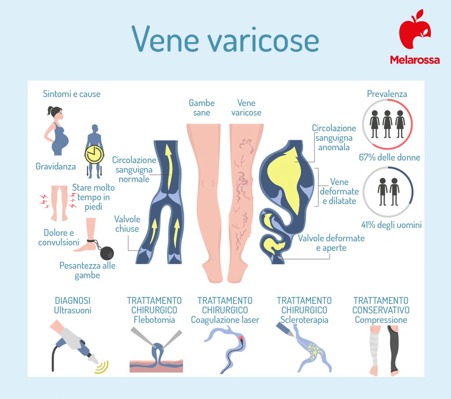 Vene varicose: cosa sono, sintomi, cause e rimedi delle varici
