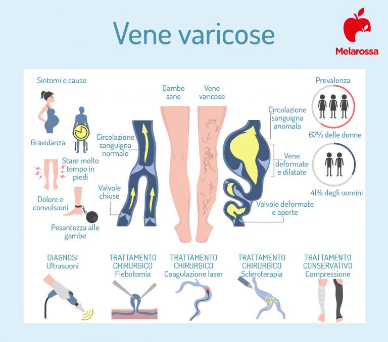 Vene varicose: cosa sono, sintomi, cause e rimedi delle varici