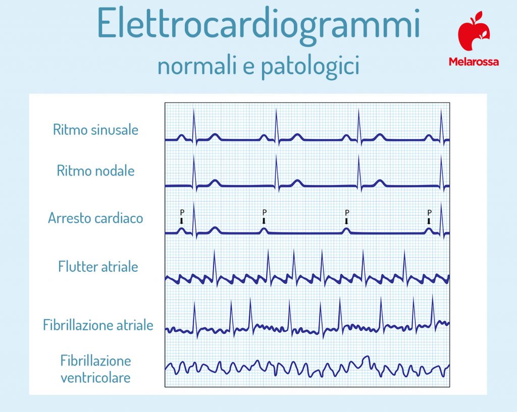Elettrocardiogramma: che cos'è, come funziona e cosa si vede