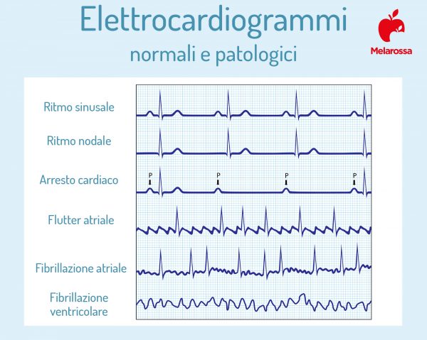 Elettrocardiogramma: che cos'è, come funziona e cosa si vede