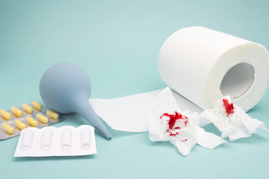 Emorroidi interne: cosa sono, sintomi, rimedi e complicanze