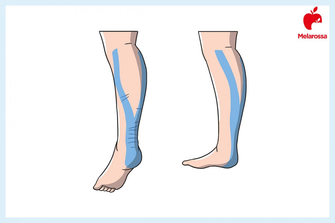Kinesio taping: che cos'è, a cosa serve, come si usa, benefici