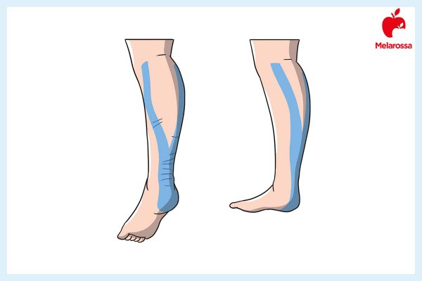 Kinesio taping: che cos'è, a cosa serve, come si usa, benefici