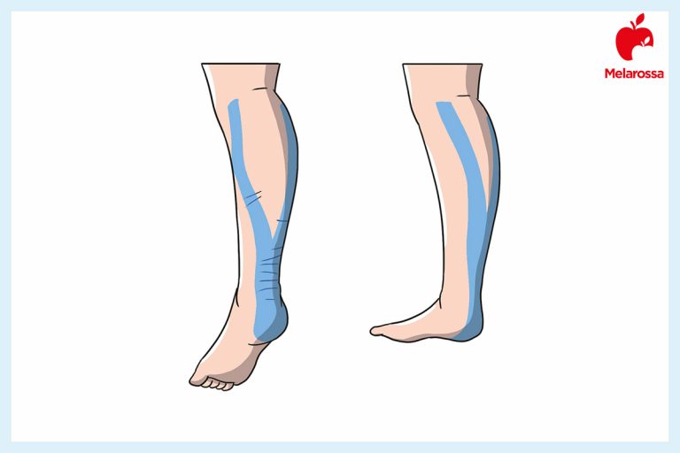 Kinesio taping: che cos'è, a cosa serve, come si usa, benefici