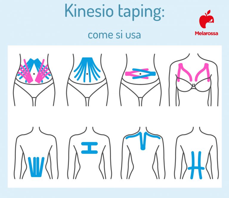Kinesio taping: che cos'è, a cosa serve, come si usa, benefici