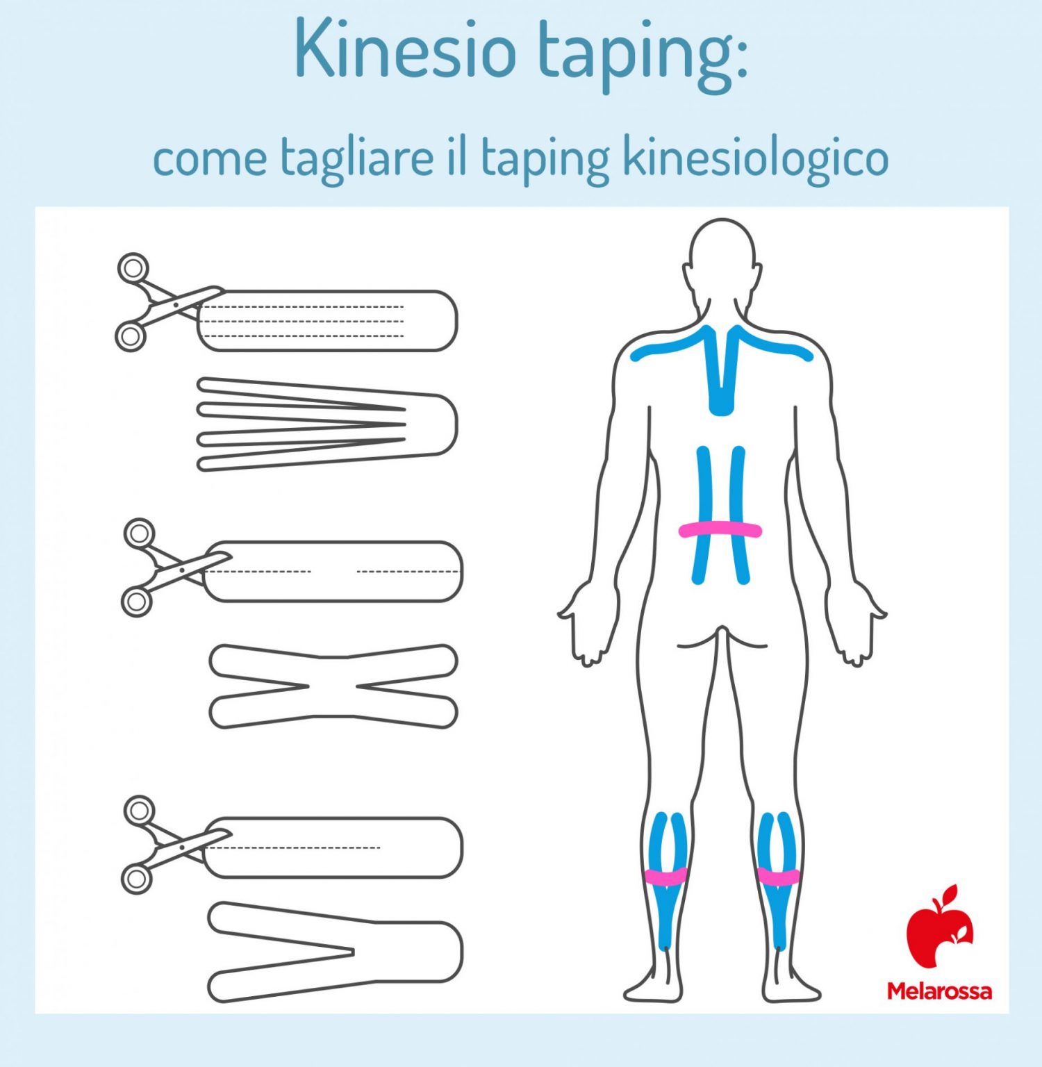 Kinesio taping: che cos'è, a cosa serve, come si usa, benefici