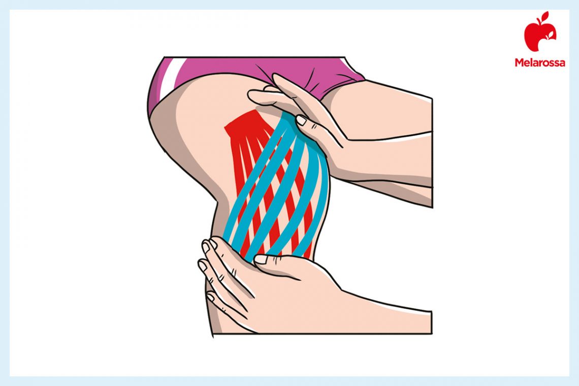 Kinesio taping: che cos'è, a cosa serve, come si usa, benefici